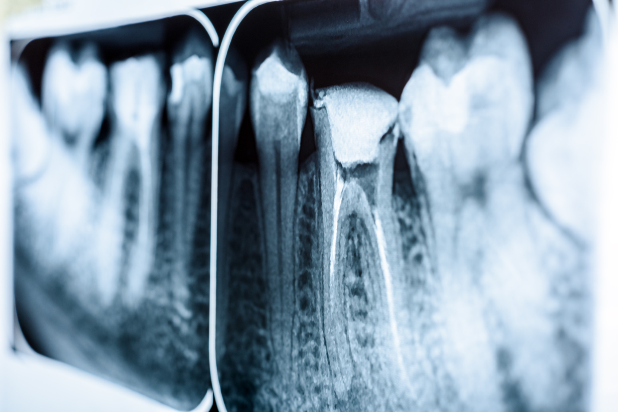 Root Canal Therapy - Zeik Dental